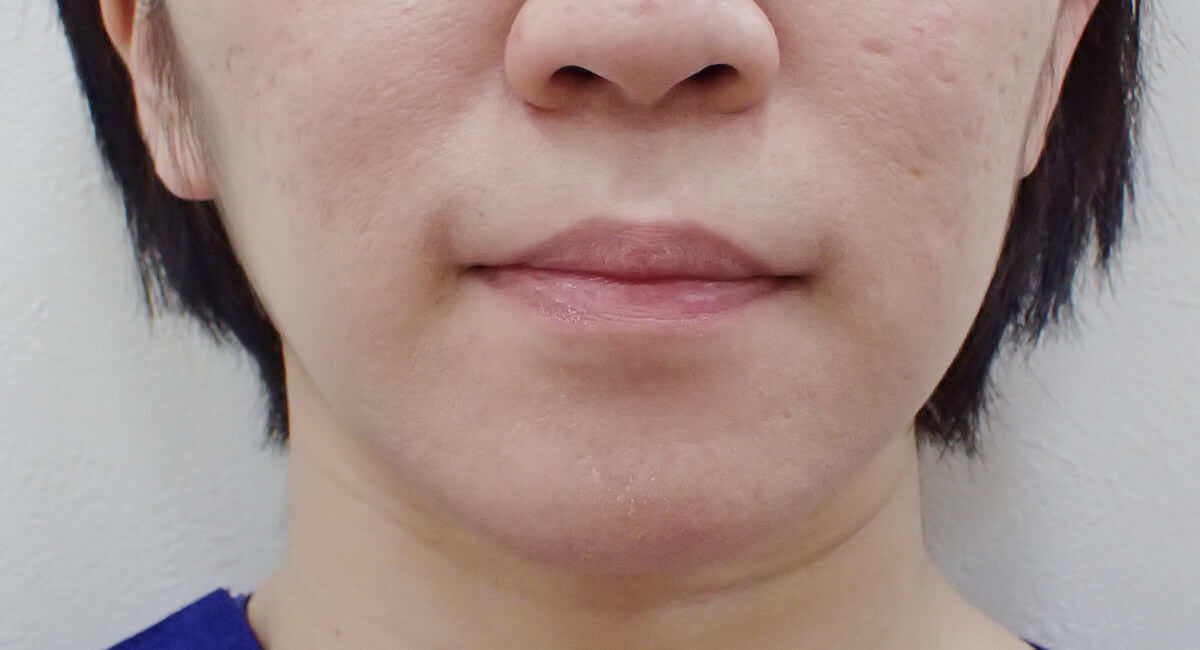 Botox Treatment ： for Face Slimming and Lip Corner Lift（Smile Lift ...