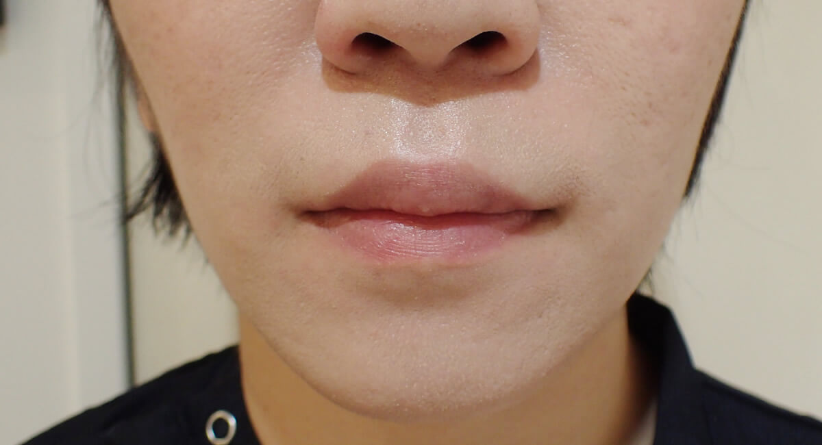 Botox Treatment ： for Face Slimming and Lip Corner Lift（Smile Lift ...