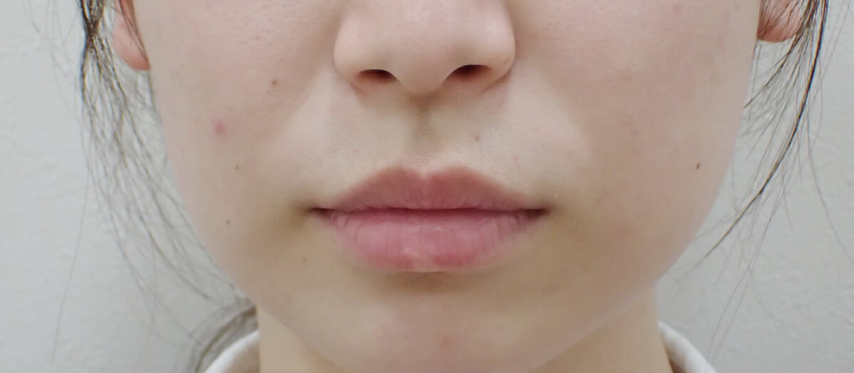 Botox Treatment ： for Face Slimming and Lip Corner Lift（Smile Lift ...